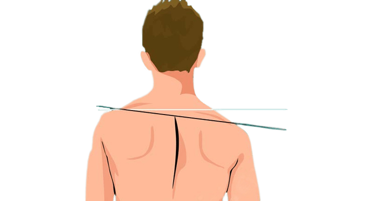 درمان افتادگی شانه در شرق تهران